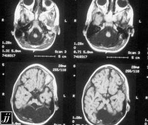 Brain – Dandy walker syndrome - Radioogle