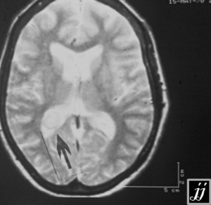 Brain – Choroidal plexus cyst - Radioogle
