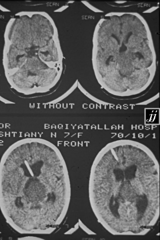 Brain – 3rd ventricular tumor and shunt - Radioogle