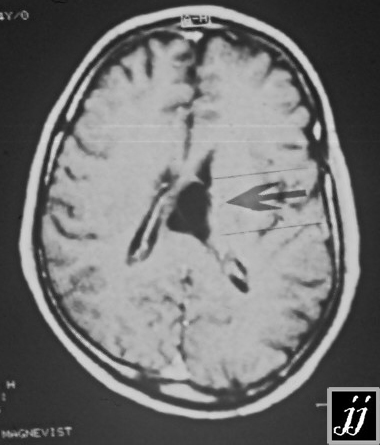 Brain – A cyst Between Ventricles - Radioogle