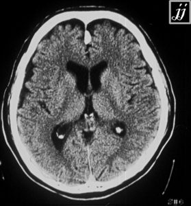 Brain – Falx calcification (2) - Radioogle