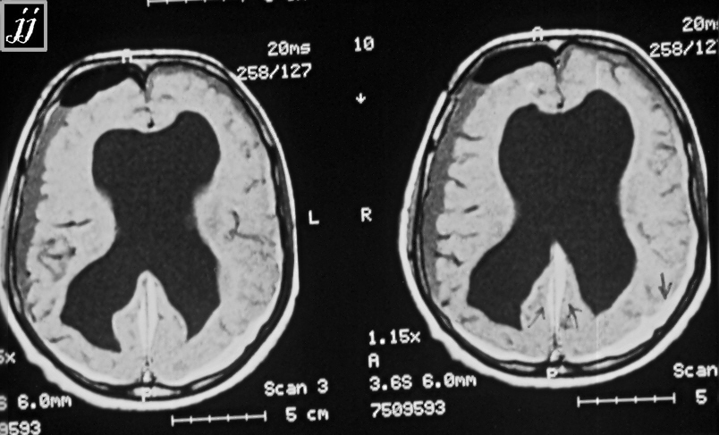 Brain – Hydrocephaly and subdural air fluid level. - Radioogle