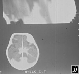 Brain – Mega cisterna magna by cisternography, dandy walker - Radioogle
