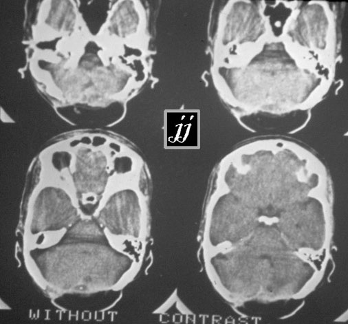 Radioogle | Brain – Epidural collection in occipital Craniectomy