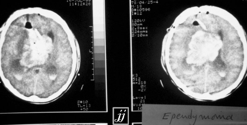 Brain – Operated Ependymoma with intraventricular hemorrhage - Radioogle