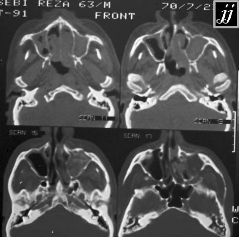 ENT – Left Maxillary hemorrhage and fracture – Radioogle