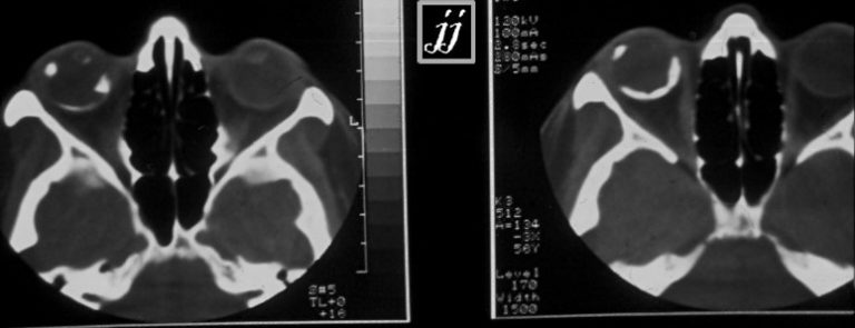 Brain – scleral calcification and blindness (2) - Radioogle