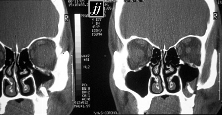 ENT – Left maxillary floor fracture - Radioogle