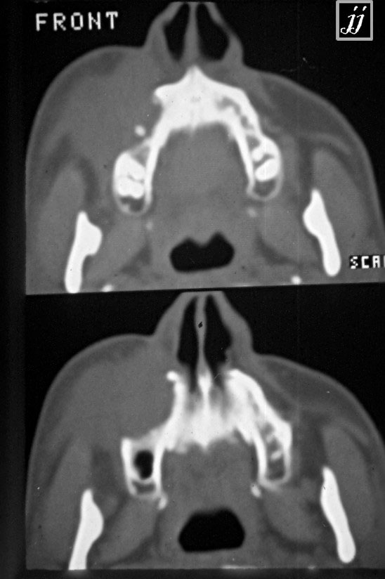 ENT – Lytic maxillary bone tumor - Radioogle