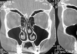 ENT – Normal Sinus anatomy - Radioogle