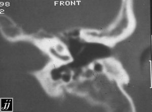 ENT – Normal tympanic membrane - Radioogle
