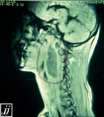 ENT – Pharyngeal abscess - Radioogle