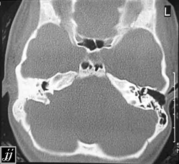 ENT – Right EAC and middle ear Atresis - Radioogle