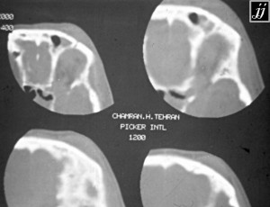 ENT – left frontal fracture - Radioogle