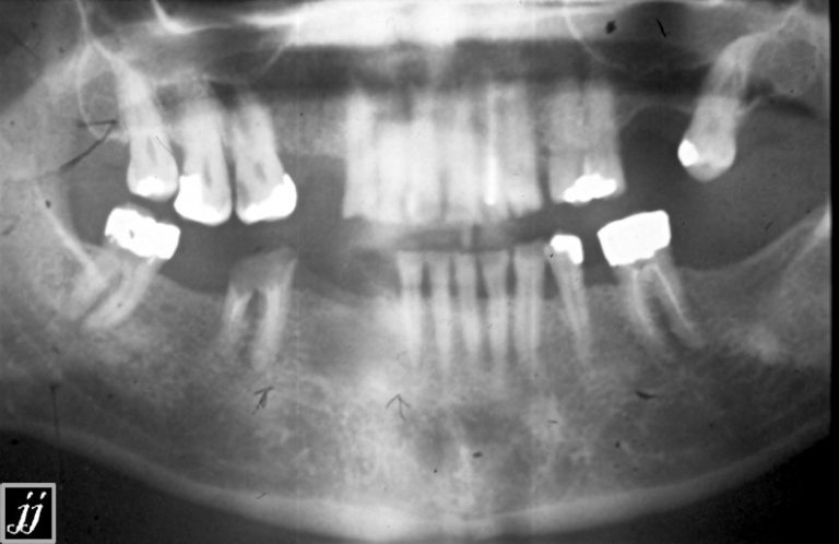ENT – mandibular cyst in dental root - Radioogle