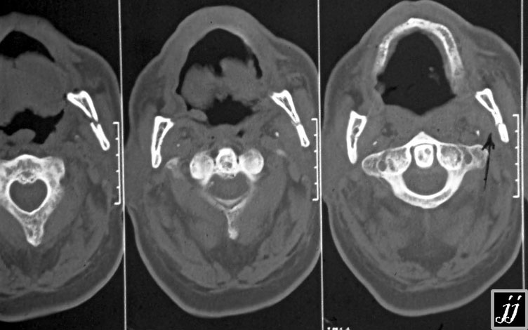 ENT – mandibular ramus fracture - Radioogle