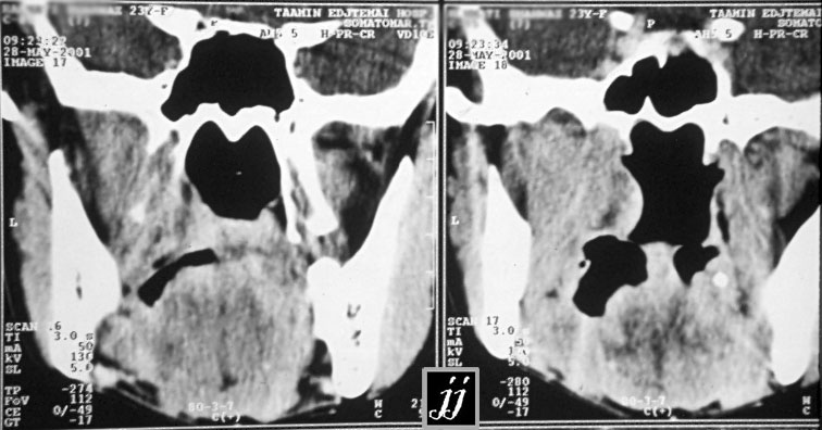 ENT – oronasopharynx tumor, hard plate tumor - Radioogle