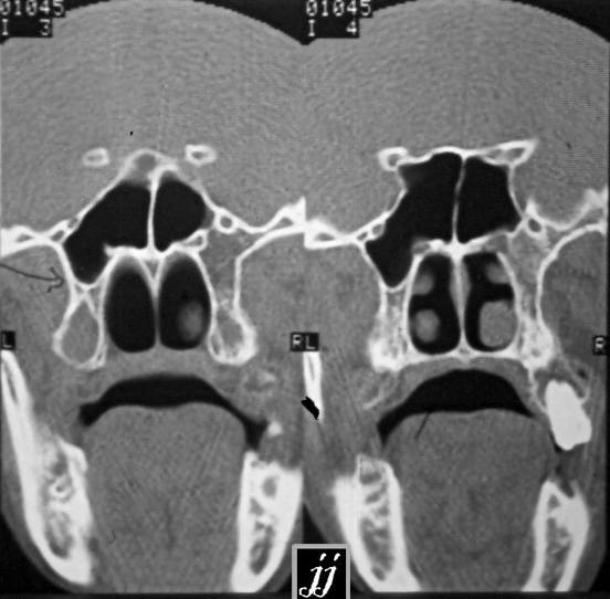 ENT – pneumatized left pterygoid recess of Sphenoidal sinus - Radioogle