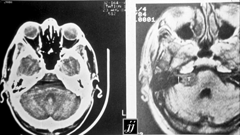 ENT – Vestibular schwannoma comparing non contrasted CT and non ...