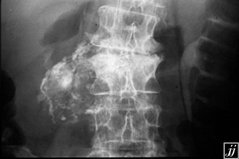 SPINE – Calcified tuberculosis abscess para spinal - Radioogle