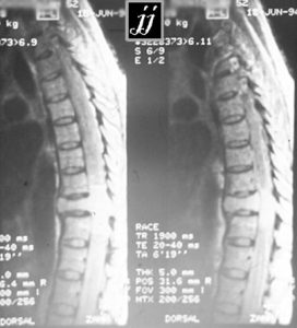 SPINE – Dorsal vertebra compression fracture, pathologic - Radioogle