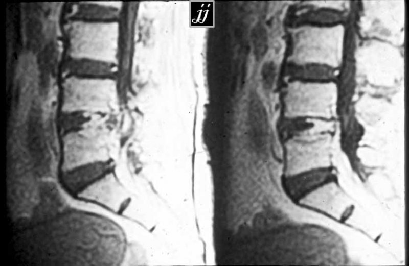 SPINE – disc and epidural scar enhancement in post OP - Radioogle