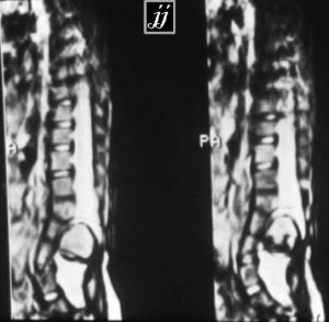 SPINE – lumbar Dural ectasis and lipoid tumor - Radioogle