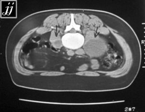 SPINE – tuberculosis abscess in psoas muscles - Radioogle