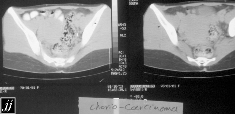 Abdomen – chorio-carcinoma - Radioogle