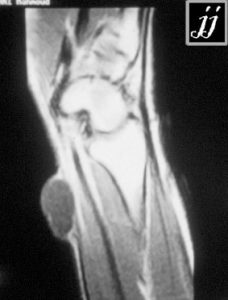 MSK – Distal forearm subcutaneous mass - Radioogle