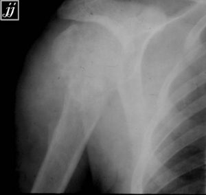 MSK – Proximal humerus osteogenic sarcoma and fracture - Radioogle