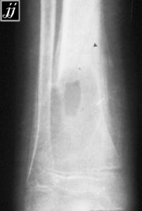 MSK – distal tibial osteogenic sarcoma - Radioogle