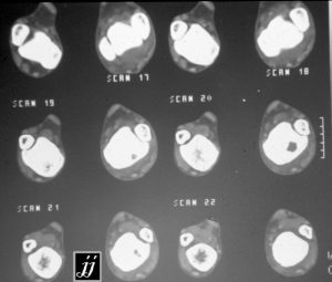 MSK – distal tibial subchondral bone defect - Radioogle