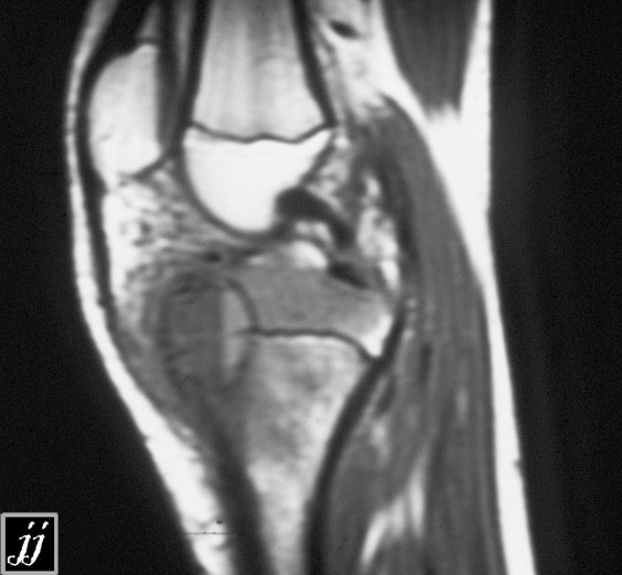 MSK – proximal tibial osteogenic sarcoma - Radioogle