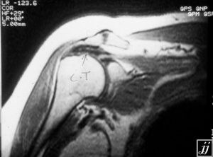 MSK – rotator cuff calcification, calcaria tendonitis - Radioogle