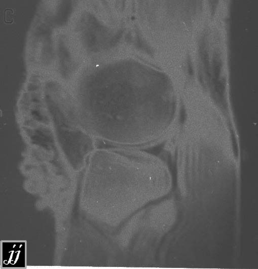 MSK – skin lesion in lateral knee - Radioogle