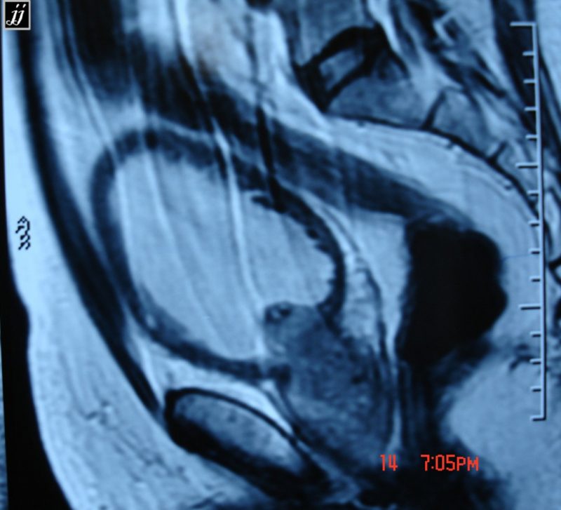 Abdomen – Cystitis and BPH (2) – Radioogle