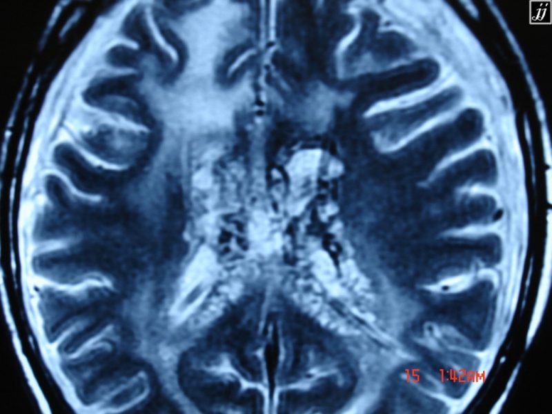 Brain – Craniopharyngioma phosphorous injection and shunt, Subdural ...
