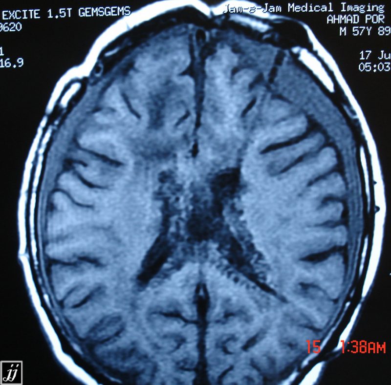 Brain – Craniopharyngioma phosphorous injection and shunt, Subdural ...