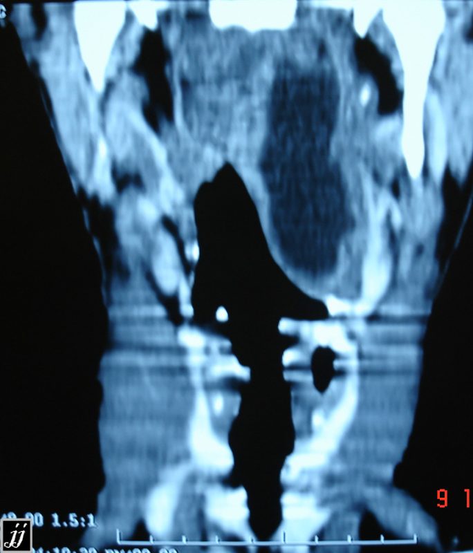 ENT – coronal reaction of pharyngeal abscess (2) - Radioogle