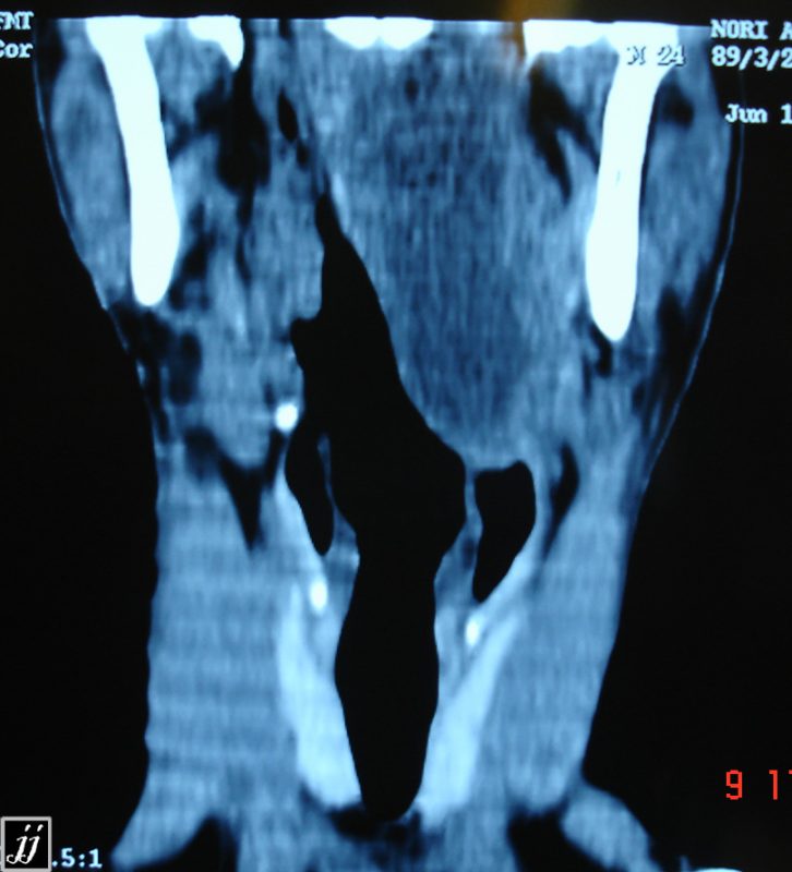 ENT – coronal reaction of pharyngeal abscess - Radioogle