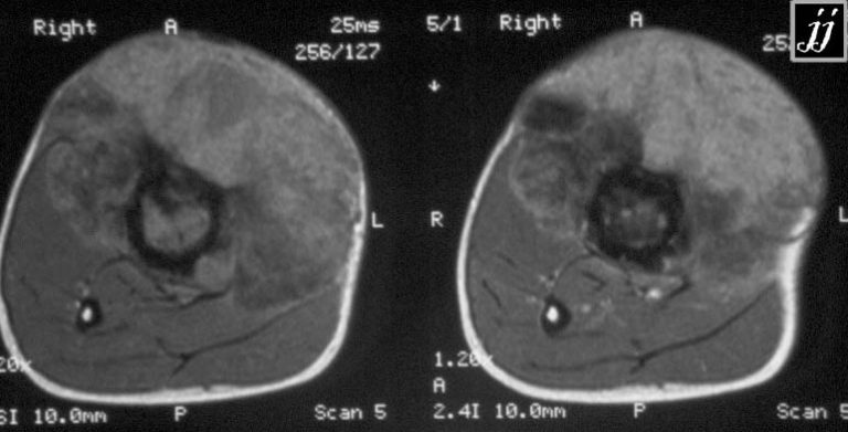 MSK – Anterior leg tibial tumor, osteogenic sarcoma - Radioogle