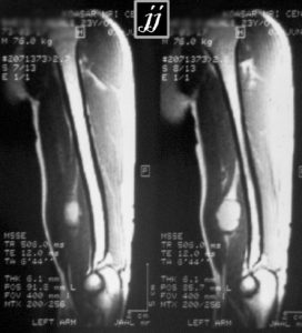 Radioogle | MSK – distal arm soft tissue tumor