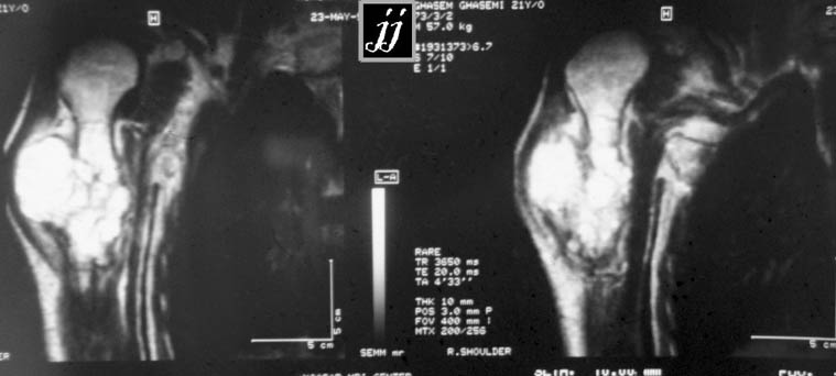 MSK – proximal femoral osteogenic sarcoma - Radioogle