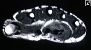 MSK – ganglion cyst around flexor tendon, hand, T1 - Radioogle