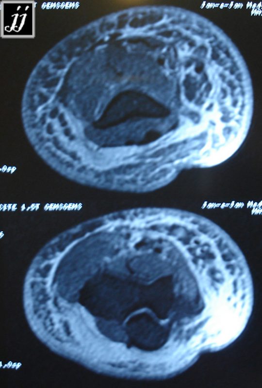 MSK – subcutaneous cellulitis and lymphatic edema after axially and ...
