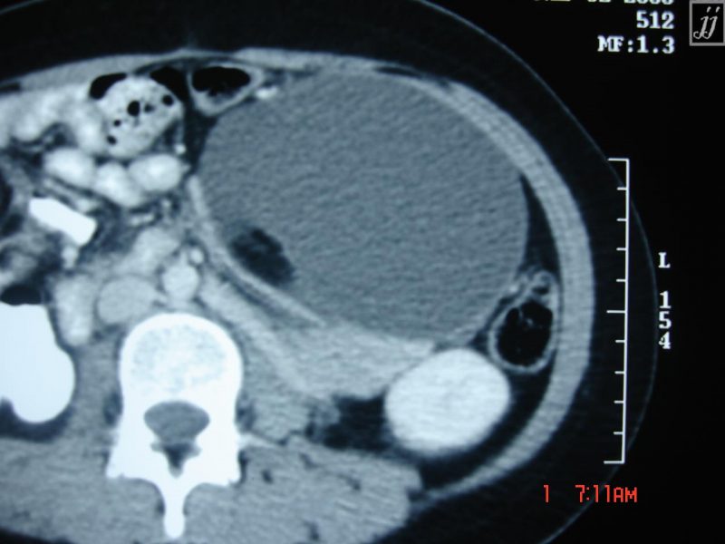 Abdomen – Abdominal wall abscess (12) - Radioogle