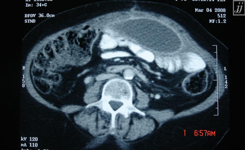 Abdomen – Abdominal wall abscess (4) - Radioogle