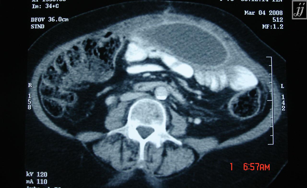 Abdomen – Abdominal wall abscess (4) - Radioogle