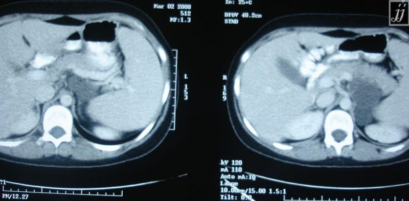 Abdomen – Abdominal wall abscess (7) - Radioogle